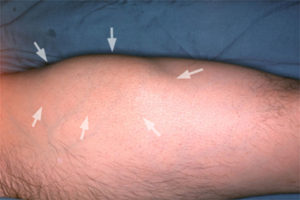 Hematoma Management - Motion Is Medicine